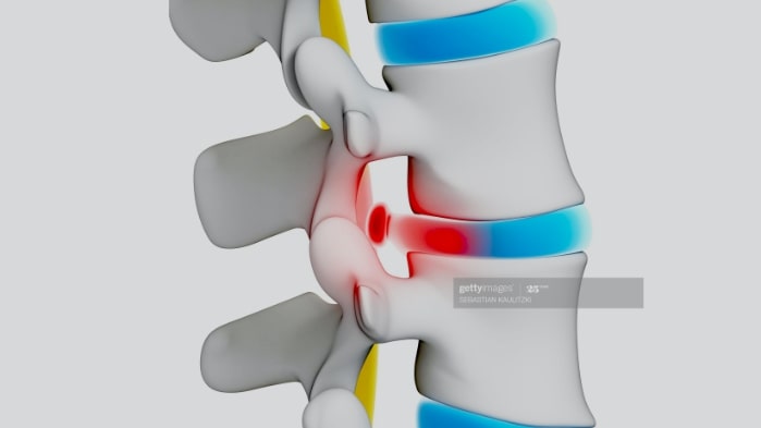 herniated-disc-spinal-condition – Advanced Disc Replacement