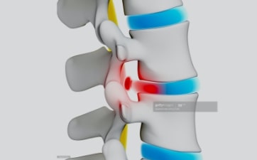 herniated-disc – Advanced Disc Replacement