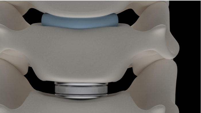 spinal-stenosis-spinal-condition – Advanced Disc Replacement