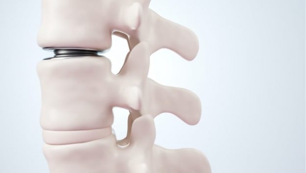 spondylolisthesis-spinal-condition – Advanced Disc Replacement